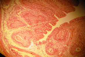 Lesion Scores of Bursa Cloacae in Broiler | Engormix